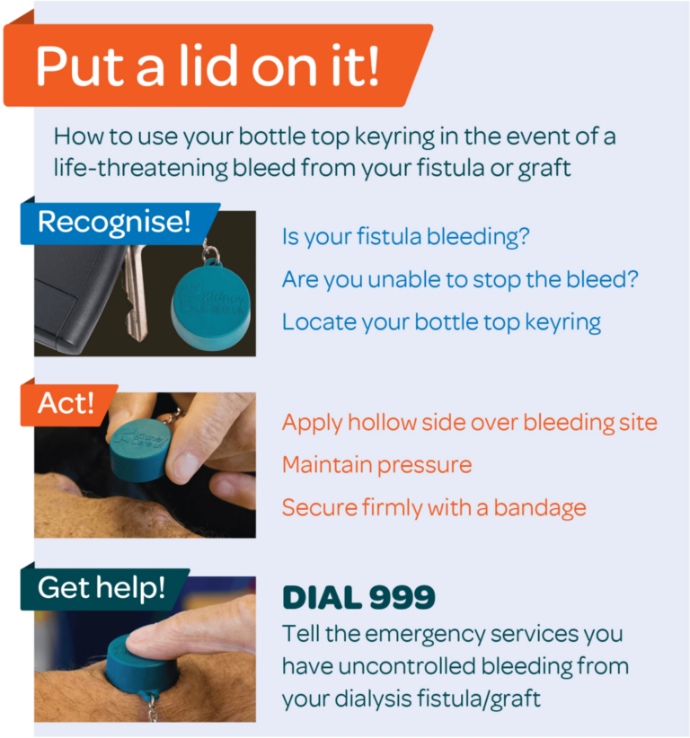 Fistula caps for dialysis patients - Kidney Wales